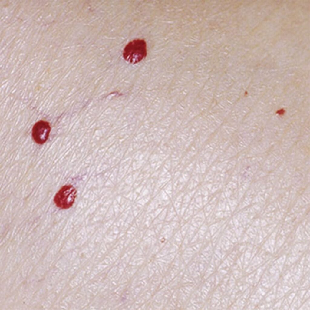 Décryptage des marques rouges sur la peau : quelles significations ...