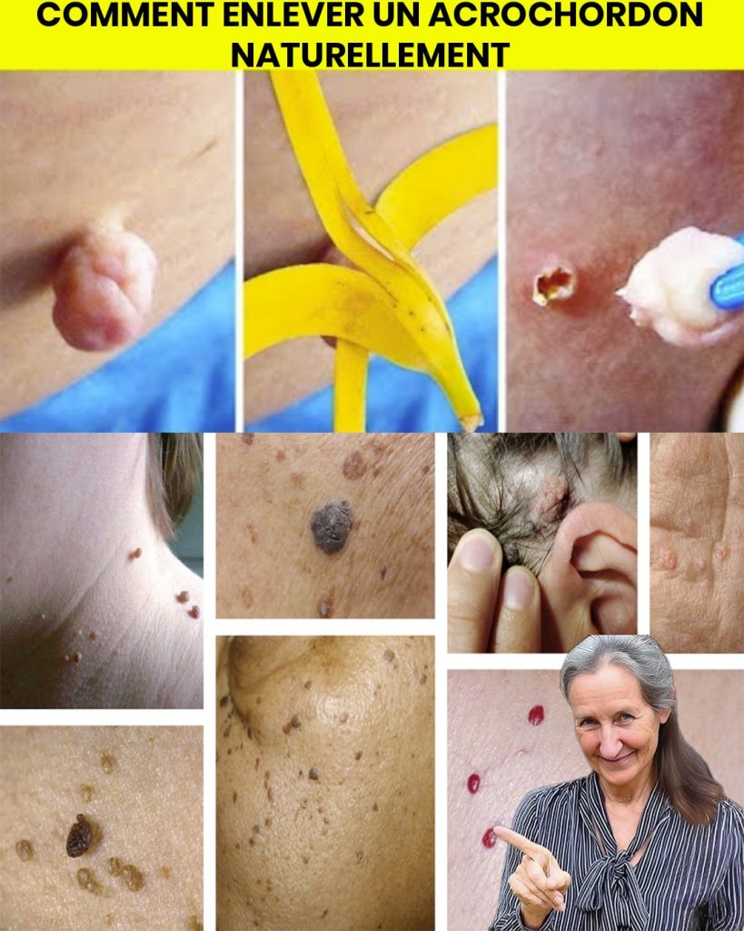 Solutions naturelles pour se débarrasser des petites excroissances ...